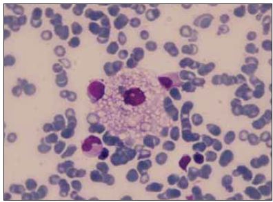 Niemann Pick Foam Cells
